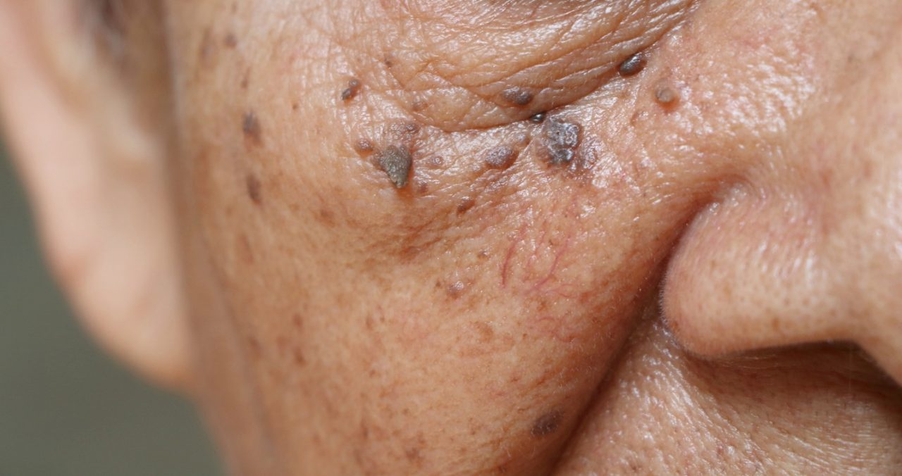 Lumps and Bumps | Reskin Medical